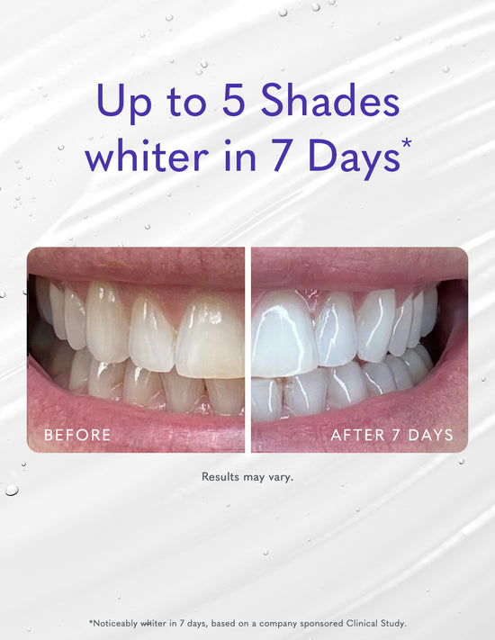 Professional Teeth Whitening Gel (Large) – smileactives
